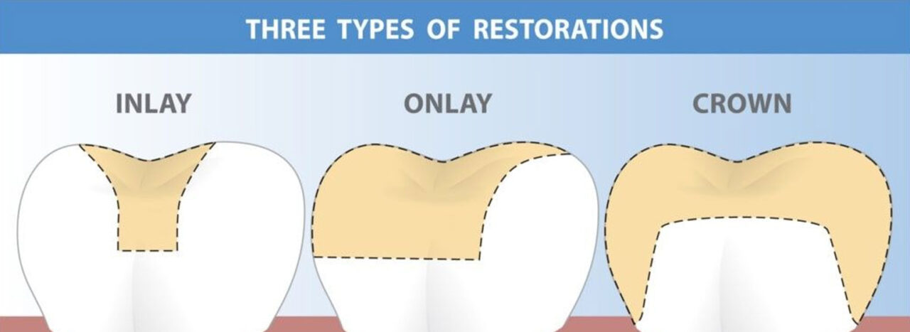 Inlays And Onlays - Clovis Country Dental