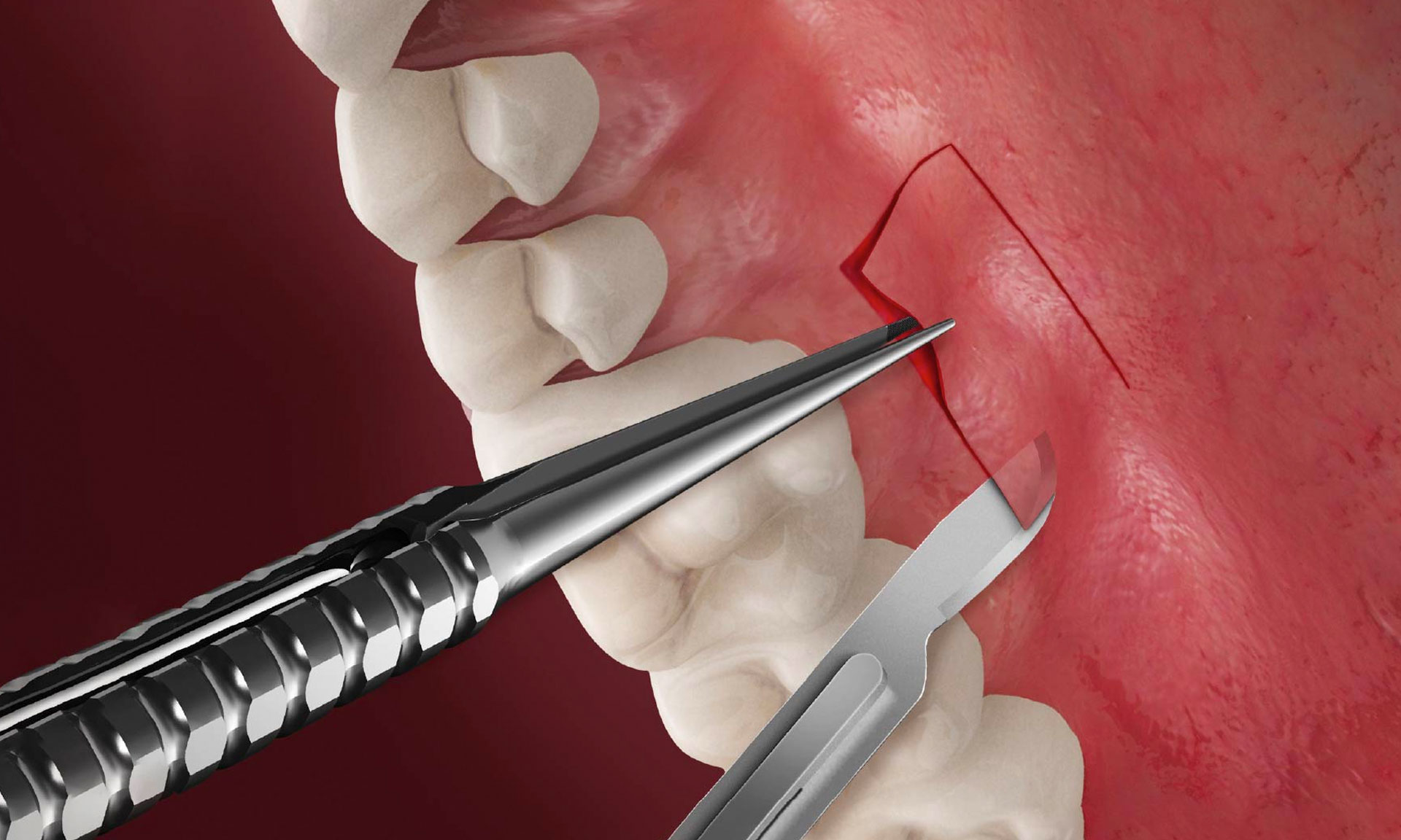 Soft Tissue Graft Clovis Country Dental